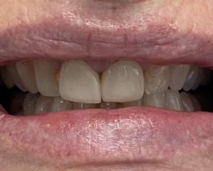 Veneers - mbcosmeticdentistry